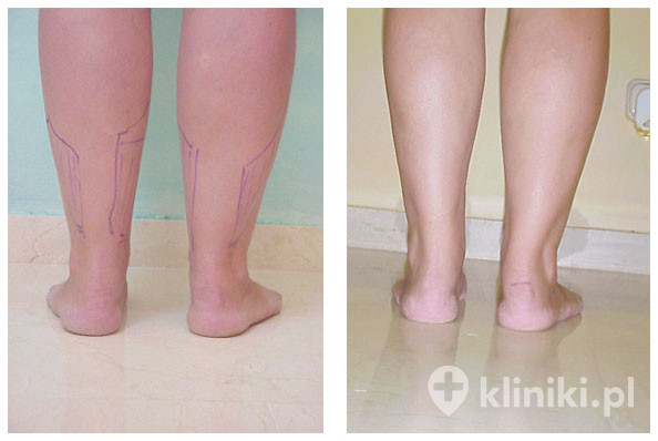 Liposukcja - odsysanie tłuszczu - zdjęcia przed i po | Kliniki.pl