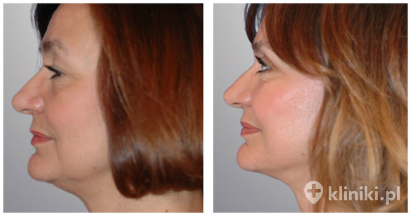 Liposukcja podbródka i chomików - zdjęcia przed i po | Kliniki.pl