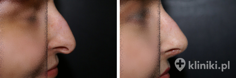 Operacja nosa chrzęstnego / czubka nosa - zdjęcia przed i po | Kliniki.pl