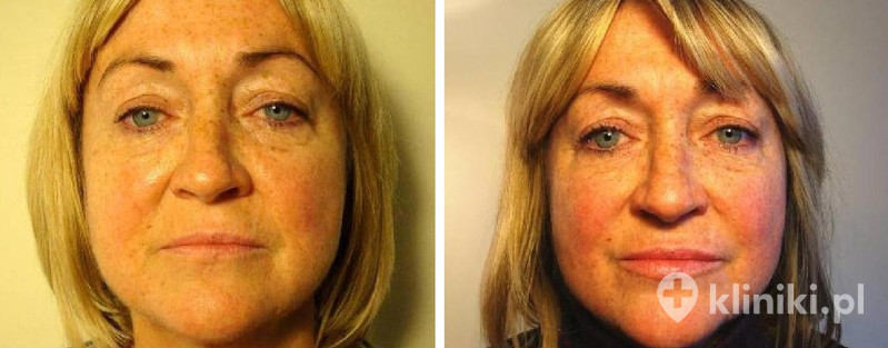 Operacje plastyczne ust - zdjęcia przed i po | Kliniki.pl