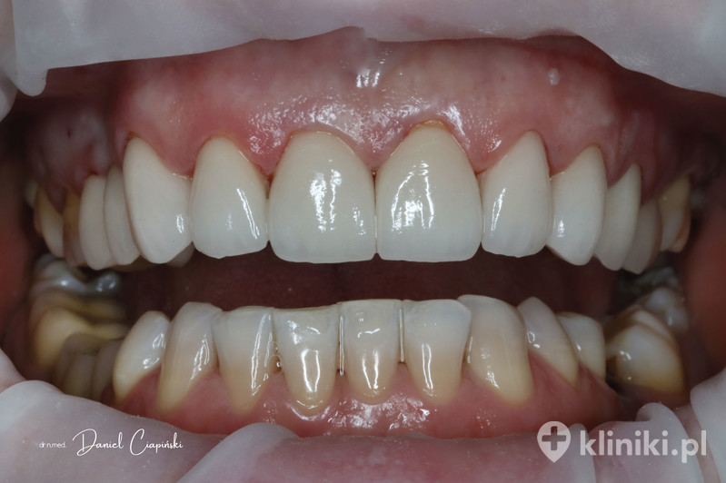 Licówki - zdjęcia przed i po | Kliniki.pl