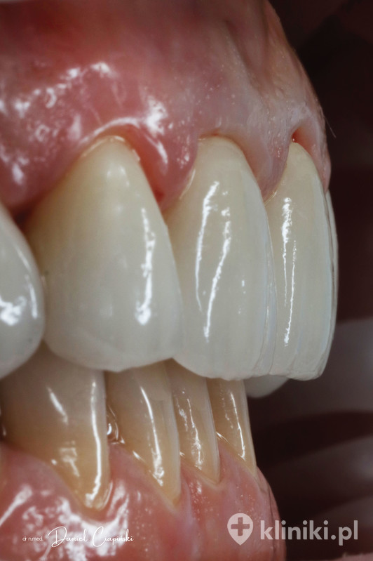 Licówki - zdjęcia przed i po | Kliniki.pl