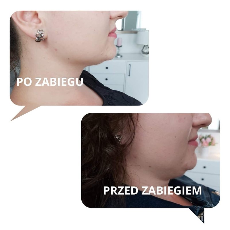 Lipoliza iniekcyjna - usuwanie tkanki tłuszczowej - zdjęcia przed i po ...
