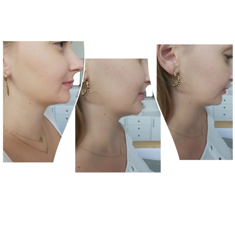 Lipoliza iniekcyjna - usuwanie tkanki tłuszczowej - zdjęcia przed i po ...