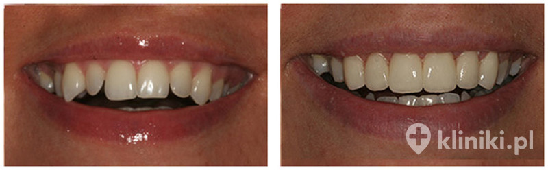 Licówka porcelanowa - zdjęcia przed i po | Kliniki.pl