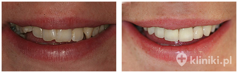 Licówka porcelanowa - zdjęcia przed i po | Kliniki.pl