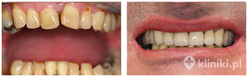 Licówka porcelanowa - zdjęcia przed i po | Kliniki.pl