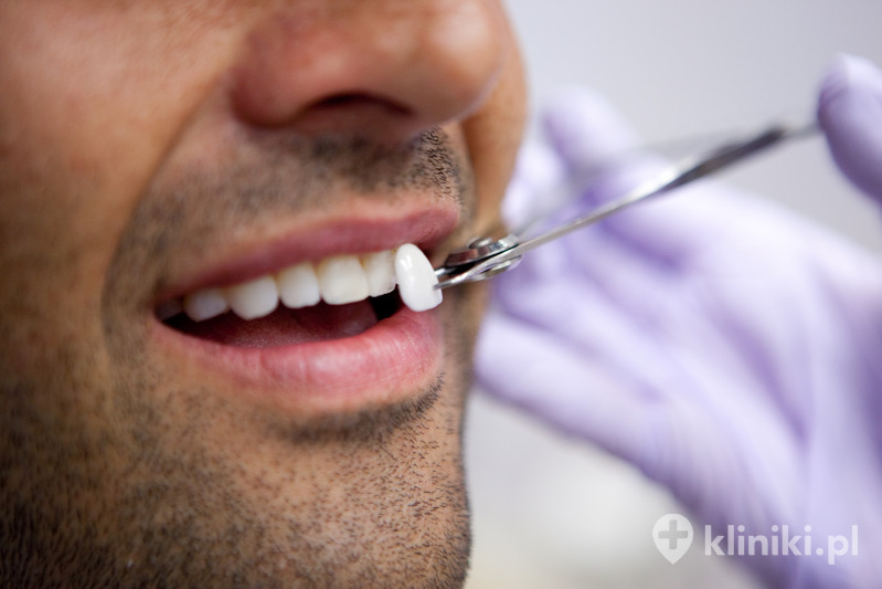 Piękne i białe zęby dzięki licówkom | Kliniki.pl