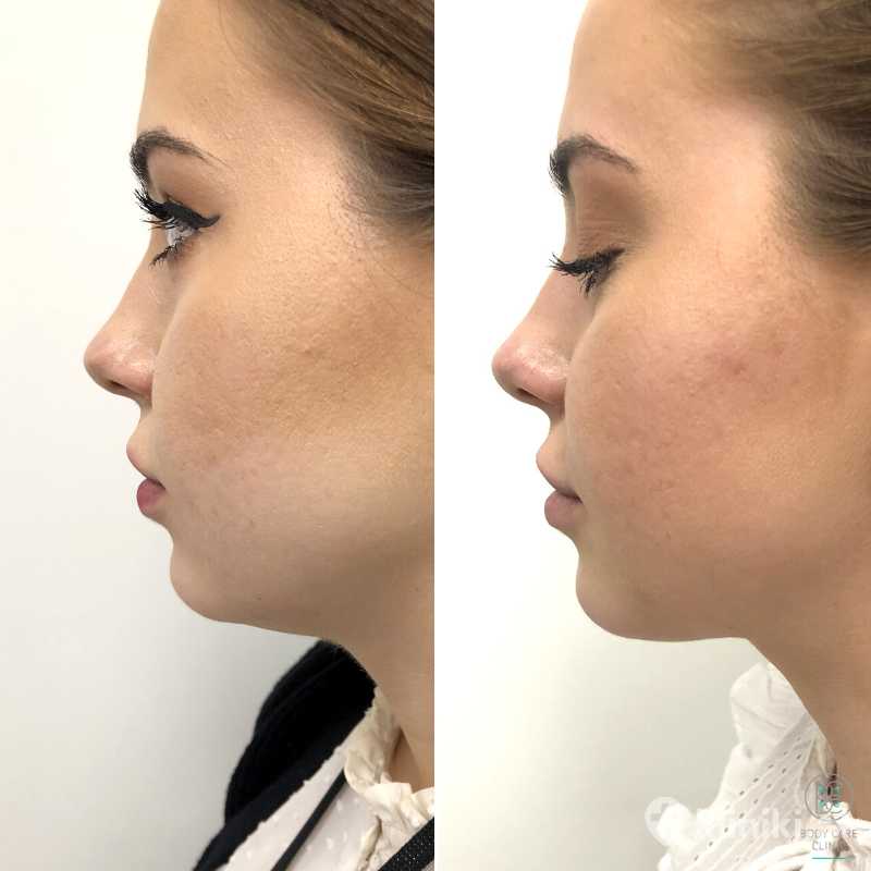 Lipoliza iniekcyjna - usuwanie tkanki tłuszczowej - zdjęcia przed i po ...