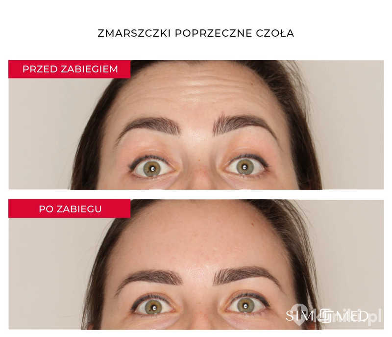 Zabiegi z użyciem botoksu - zdjęcia przed i po | Kliniki.pl