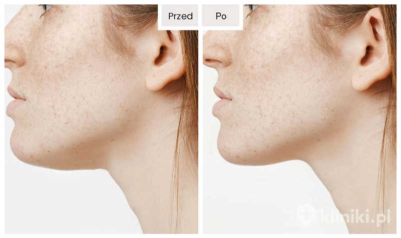 Lipoliza iniekcyjna - usuwanie tkanki tłuszczowej - zdjęcia przed i po ...