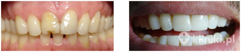 Licówki - zdjęcia przed i po | Kliniki.pl