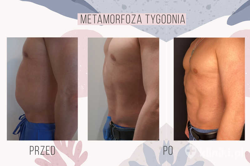 Liposukcja ultradźwiękowa Vaser Lipo - brzuch - zdjęcia przed i po ...