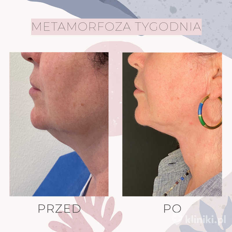 Liposukcja ultradźwiękowa Vaser Lipo - podbródek - zdjęcia przed i po ...