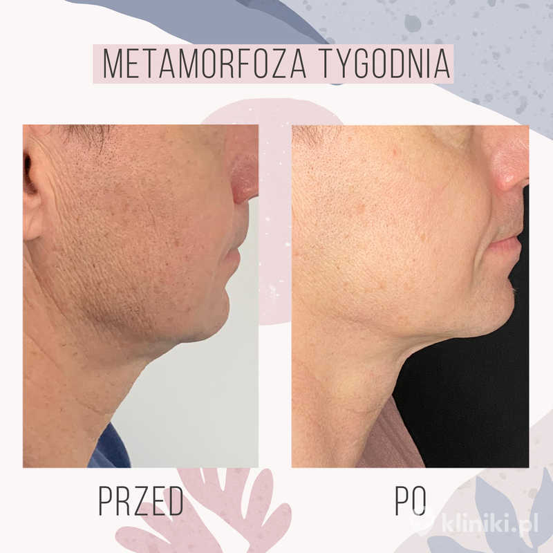 Liposukcja ultradźwiękowa Vaser Lipo - podbródek - zdjęcia przed i po ...