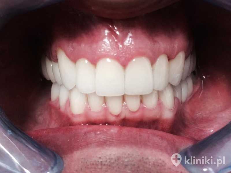 Licówka pełnoceramiczna - zdjęcia przed i po | Kliniki.pl