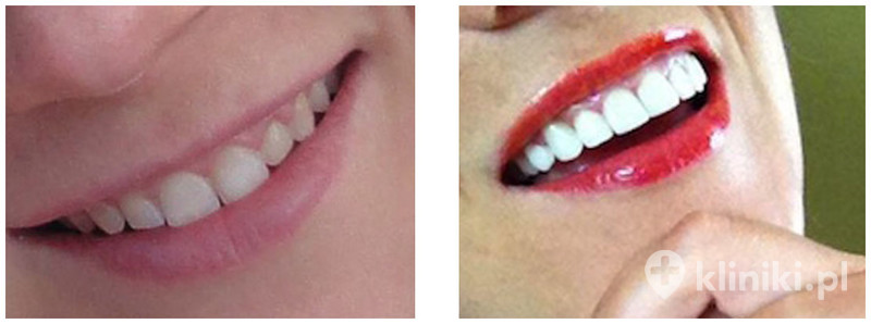 Licówki - zdjęcia przed i po | Kliniki.pl