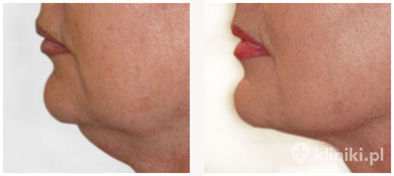 Lipoliza iniekcyjna - usuwanie tkanki tłuszczowej - zdjęcia przed i po ...