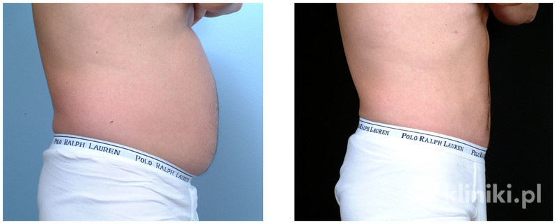 Liposukcja - odsysanie tłuszczu - zdjęcia przed i po | Kliniki.pl