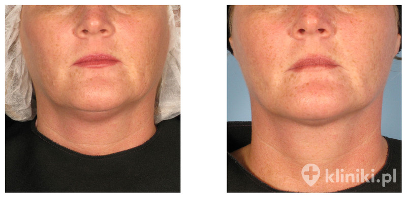 Liposukcja - odsysanie tłuszczu - zdjęcia przed i po | Kliniki.pl