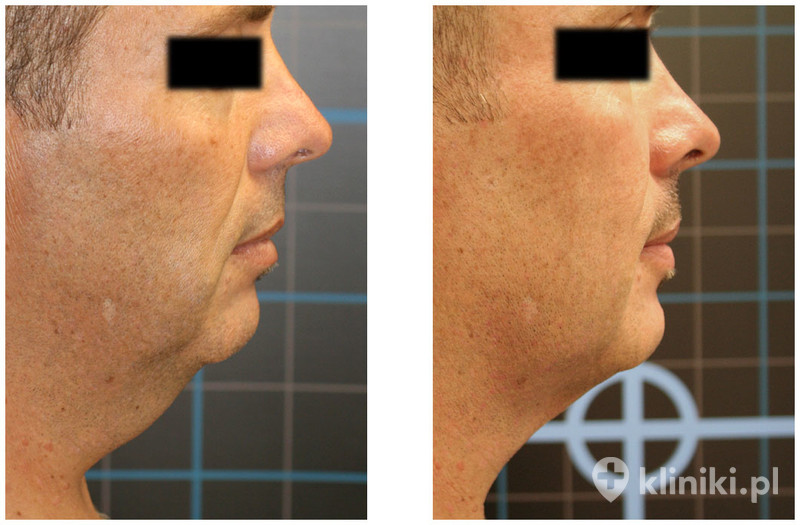 Liposukcja - odsysanie tłuszczu - zdjęcia przed i po | Kliniki.pl