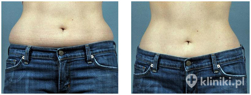 Liposukcja - odsysanie tłuszczu - zdjęcia przed i po | Kliniki.pl