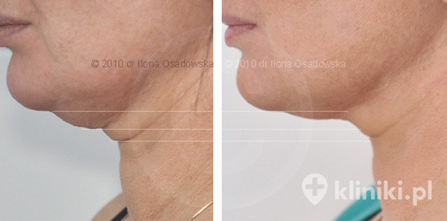 Lipoliza iniekcyjna - usuwanie tkanki tłuszczowej - zdjęcia przed i po ...