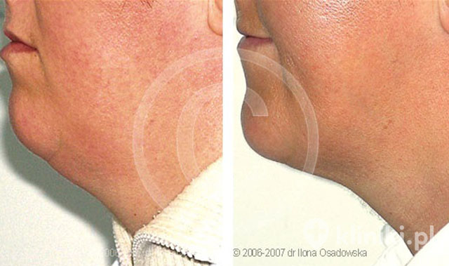 Lipoliza iniekcyjna - usuwanie tkanki tłuszczowej - zdjęcia przed i po ...
