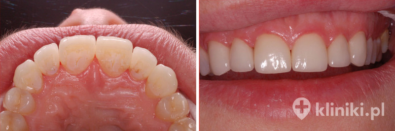 Licówki - zdjęcia przed i po | Kliniki.pl