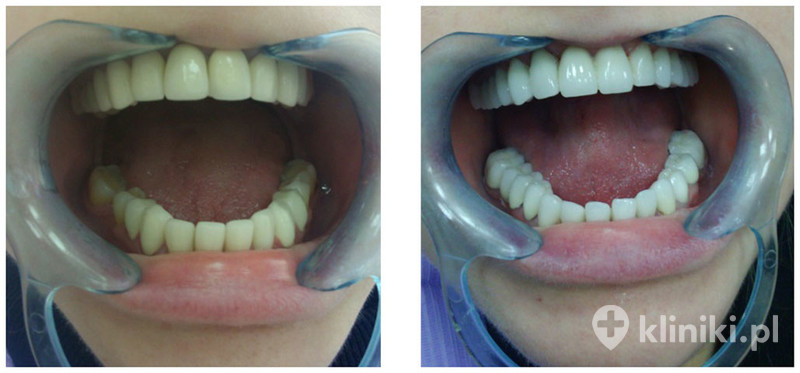 Licówki - zdjęcia przed i po | Kliniki.pl