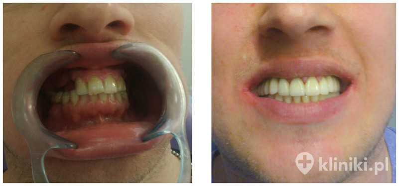 Licówka ceramiczna - zdjęcia przed i po | Kliniki.pl