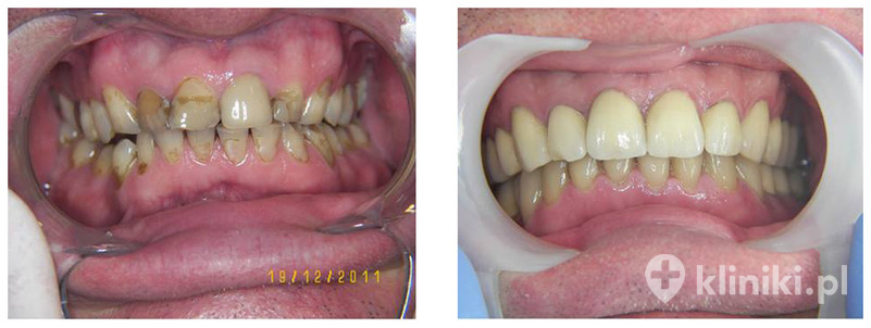 Licówka ceramiczna - zdjęcia przed i po | Kliniki.pl