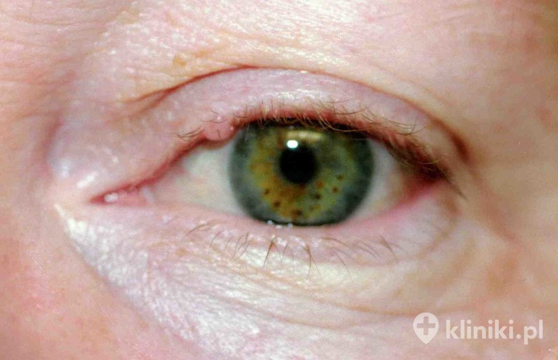 Nowotwór powieki - leczenie chirurgiczne | Kliniki.pl