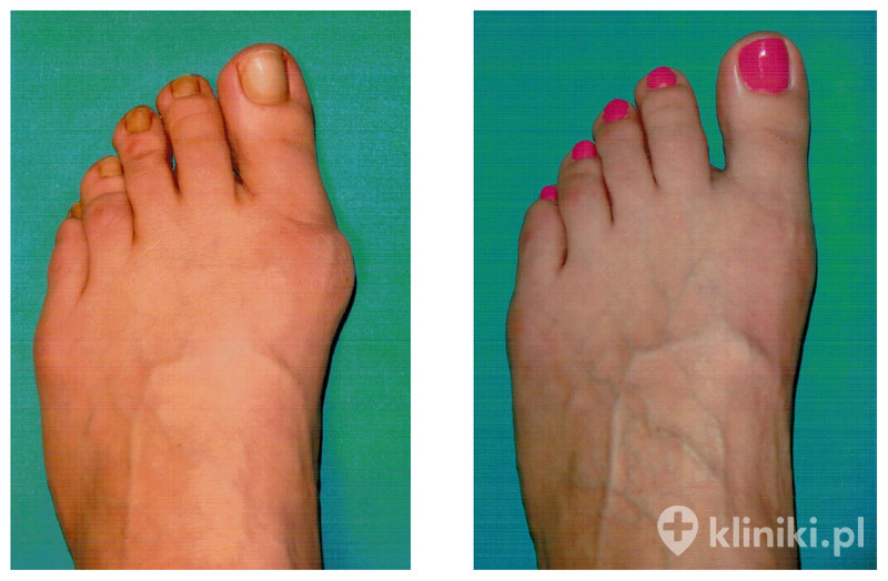 Operacje i leczenie stopy / stawu skokowego - zdjęcia przed i po ...