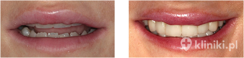Licówka porcelanowa - zdjęcia przed i po | Kliniki.pl