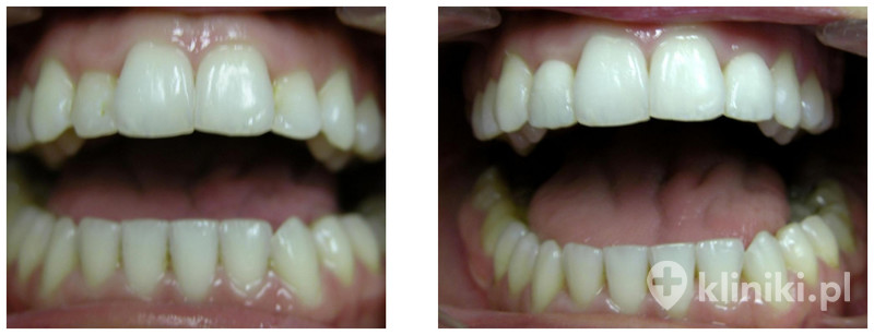 Licówka porcelanowa - zdjęcia przed i po | Kliniki.pl
