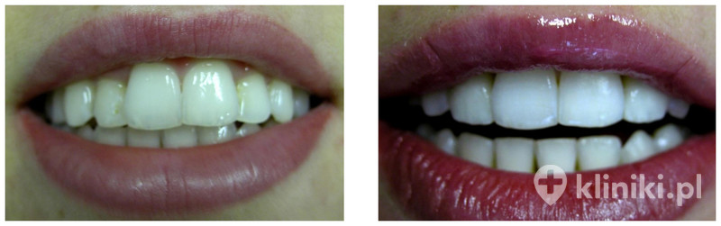 Licówka porcelanowa - zdjęcia przed i po | Kliniki.pl