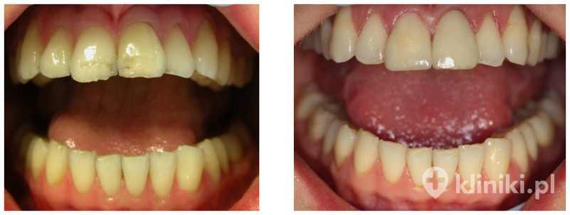 Licówka porcelanowa - zdjęcia przed i po | Kliniki.pl