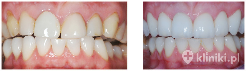 Licówka porcelanowa - zdjęcia przed i po | Kliniki.pl
