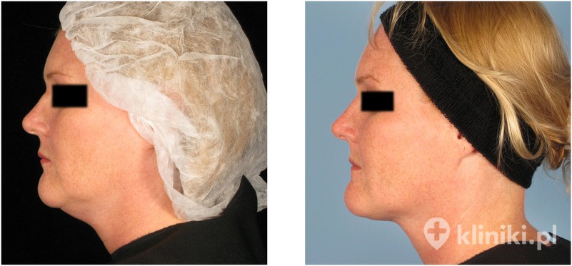 Liposukcja - odsysanie tłuszczu - zdjęcia przed i po | Kliniki.pl