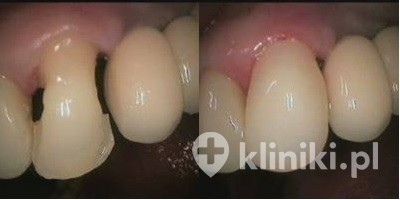 Licówka kompozytowa - zdjęcia przed i po | Kliniki.pl